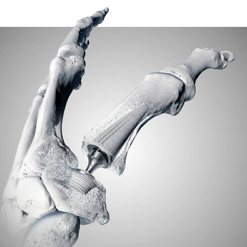 KeriMedical US | Hand and Wrist Implants and Prostheses